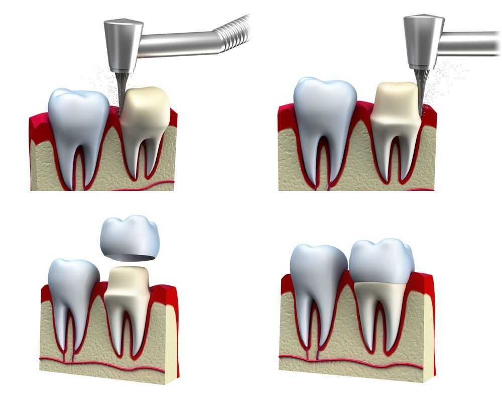 Crown Lengthening » North Branford Dentist | North Branford Dental Group